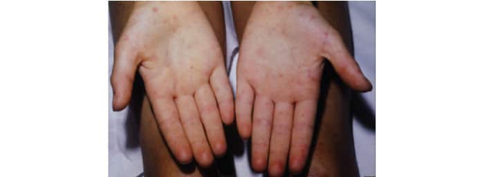 A Case of Fever and Rash | medtigo