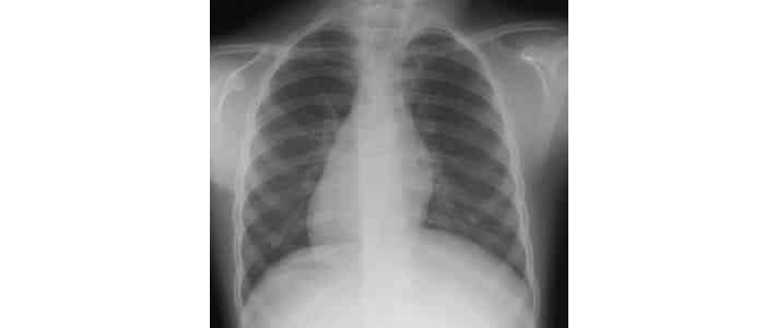 Heartbeat on the Right Side? | medtigo