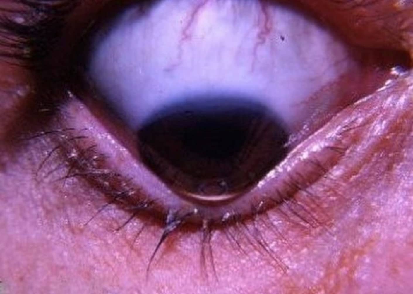 A young woman with late-onset severe myopia | medtigo