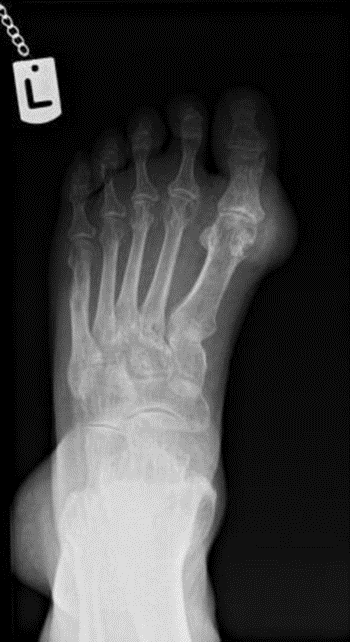 A young adult with chronic gout | medtigo