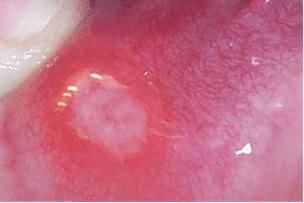 A young female with recurrent oral ulcers | medtigo