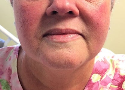 An elderly female with flushing of the skin | medtigo