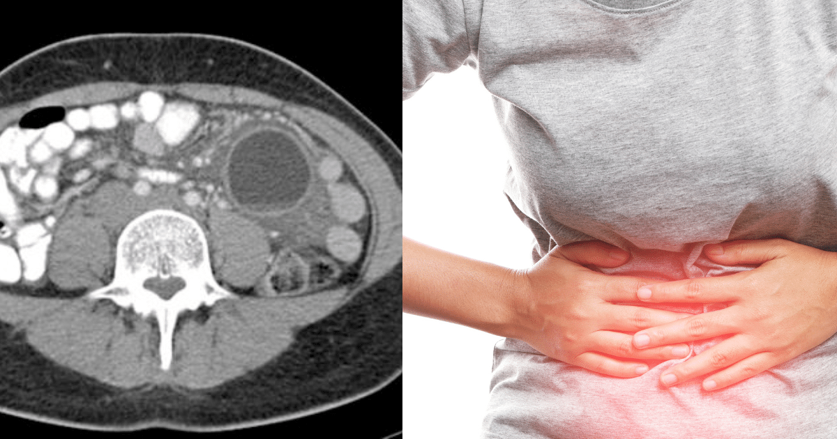 Mesenteric Cysts: Diagnosis, Management, and Surgical Excision