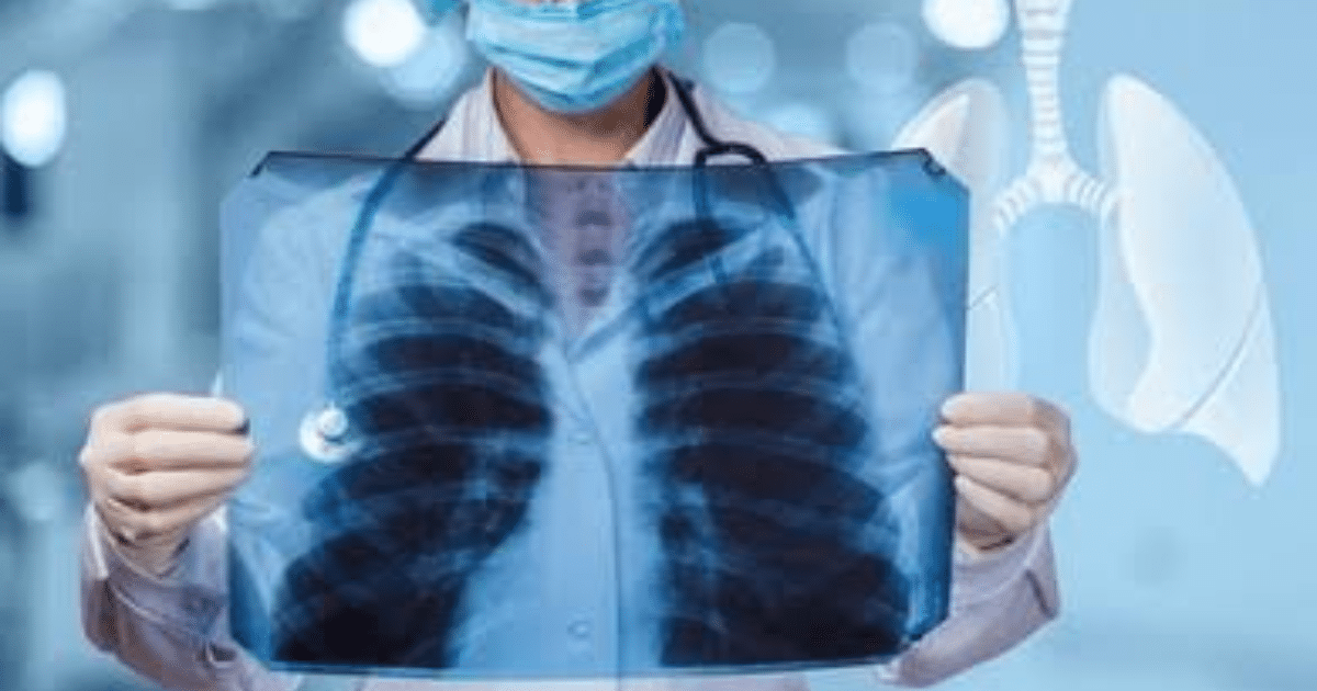 Mechanical Ventilation and VILI: Impact on ARDS