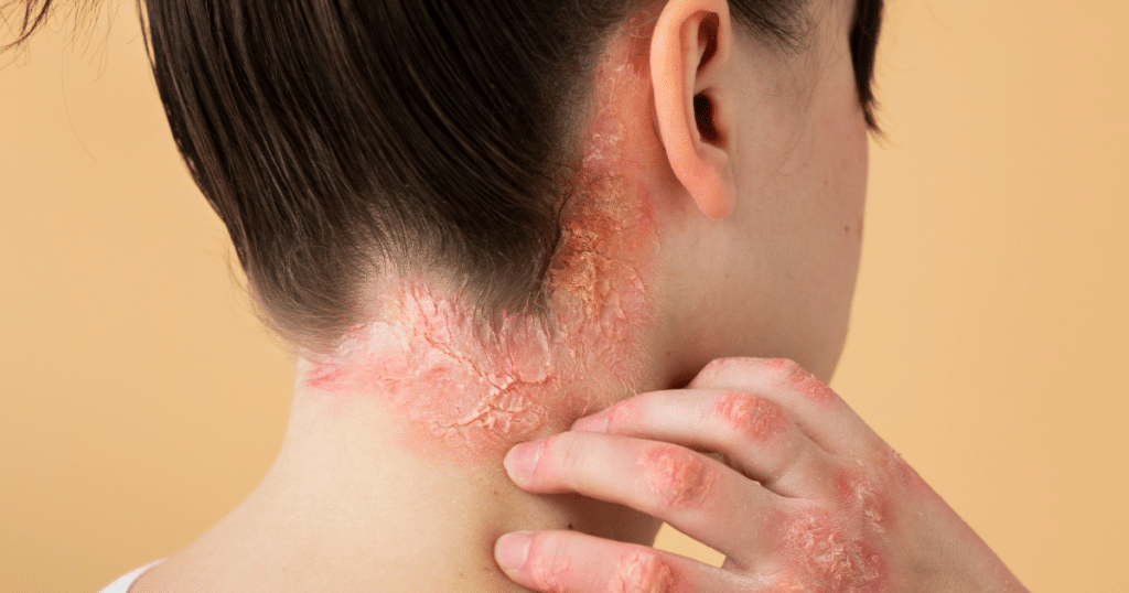 Wildfire Smoke: Can it trigger eczema & dermatitis?