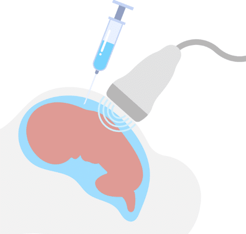 Amniocentesis | medtigo