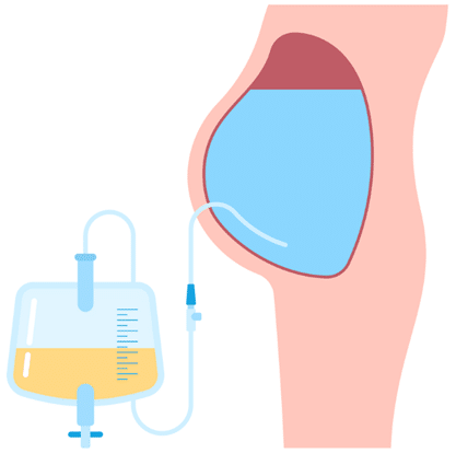 Paracentesis | medtigo