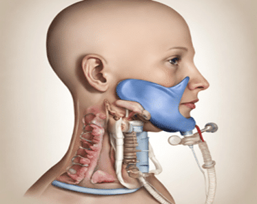 Tracheostomy | medtigo