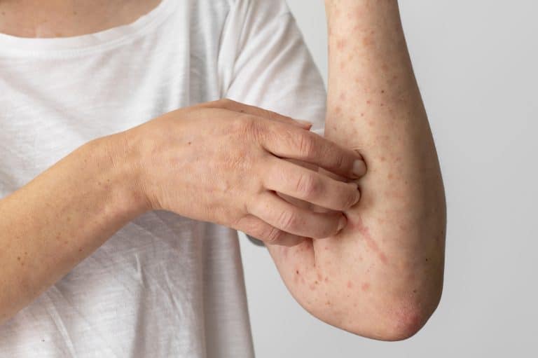 Staphylococcus Aureus Linked to Itching and Skin Damage | medtigo