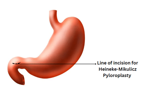 Pyloroplasty | medtigo
