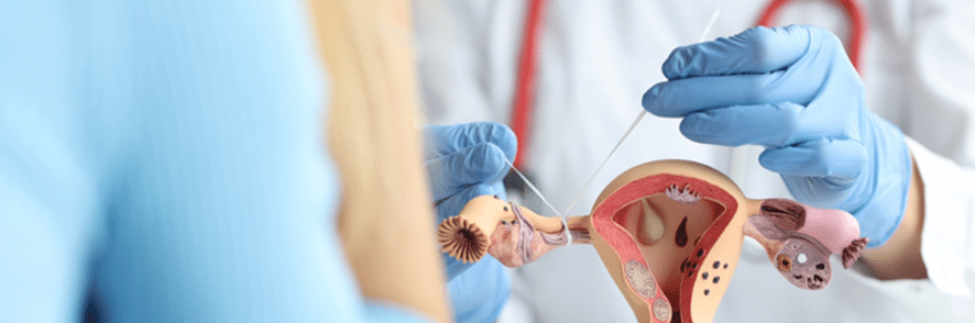 Uterine Artery Ligation | medtigo