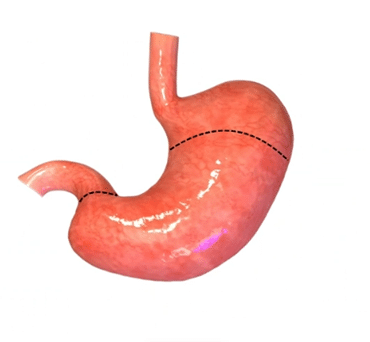 Partial Gastrectomy | medtigo