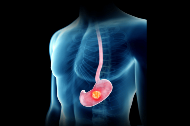 FDA Approves Tevimbra as First-Line Treatment for Gastric Cancers | medtigo