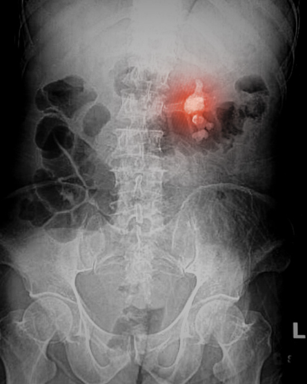 Kidneys, Ureters, and Bladder (KUB) Imaging | medtigo