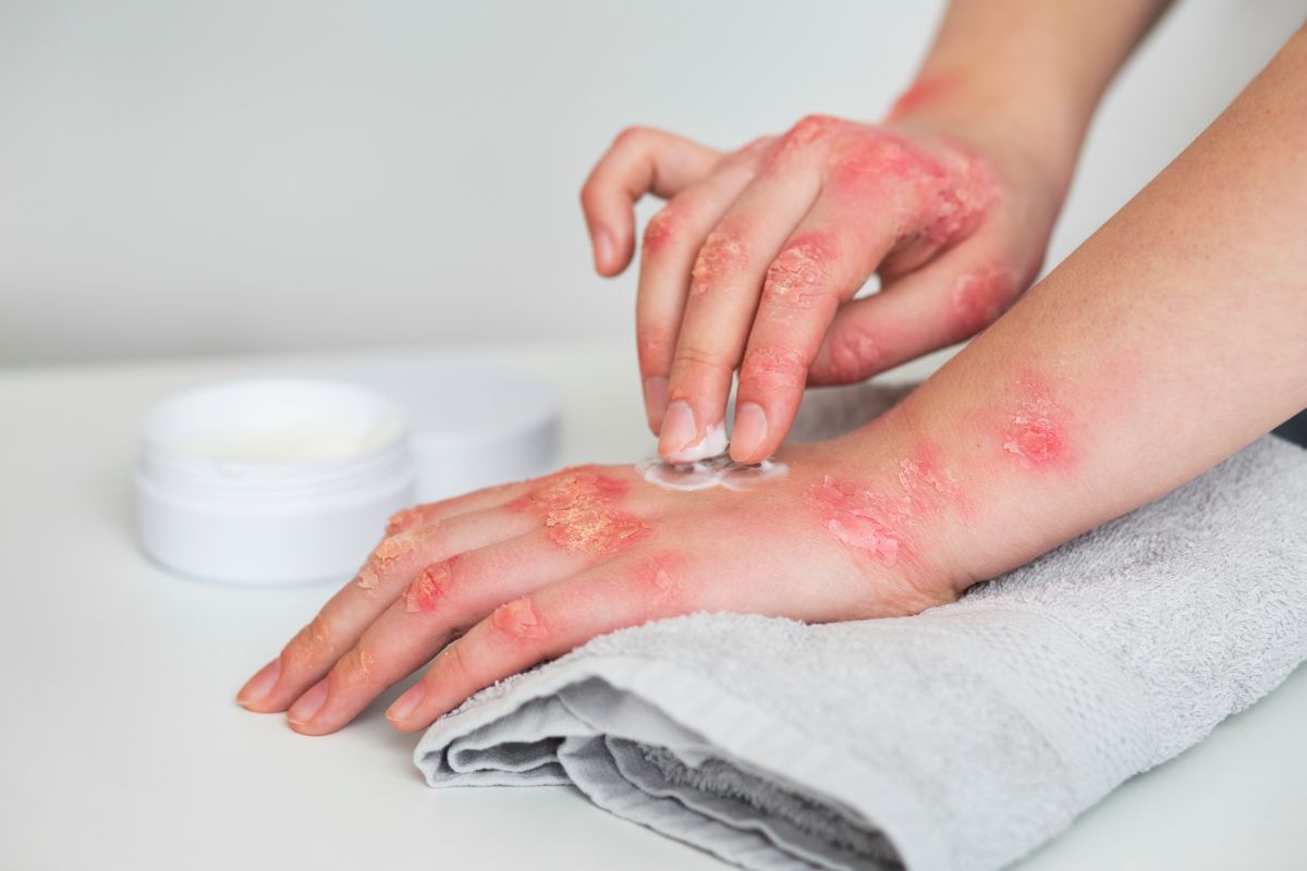 VTAMA Cream: FDA-Approved for Atopic Dermatitis | medtigo