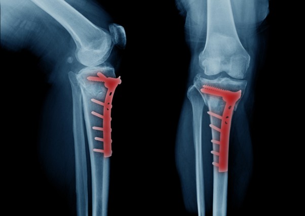 Open Reduction and Internal Fixation (ORIF) | medtigo