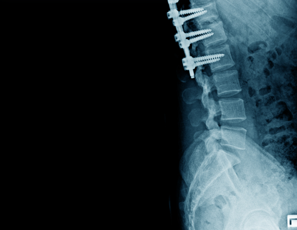 General Principles of Internal Fixation | medtigo
