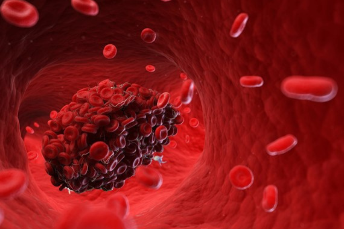 Clot-Busting Breakthrough: Stroke Treatment Window Extended to 24 Hours ...