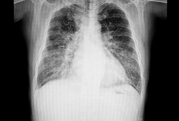 Congestive Heart Failure Imaging | medtigo