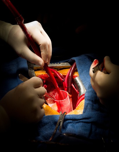 Aortic Bifemoral (Aortobifemoral) Bypass | medtigo