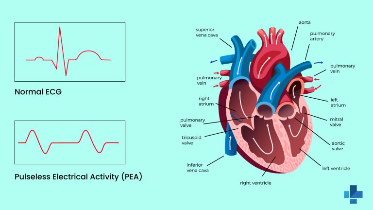 What is PEA in ACLS? Causes, Treatment, and Protocol | medtigo