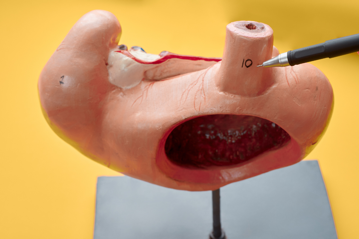 Biomarker-Based Risk Assessment Using Capsule Sponge for Barrett’s ...