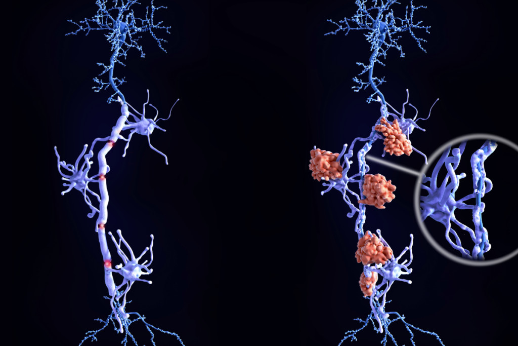Multiple Sclerosis and the Microbiome: Unbiased Functional Insights into Lachnospiraceae-Induced ...