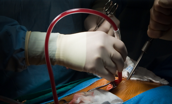 Pericardial Window | medtigo