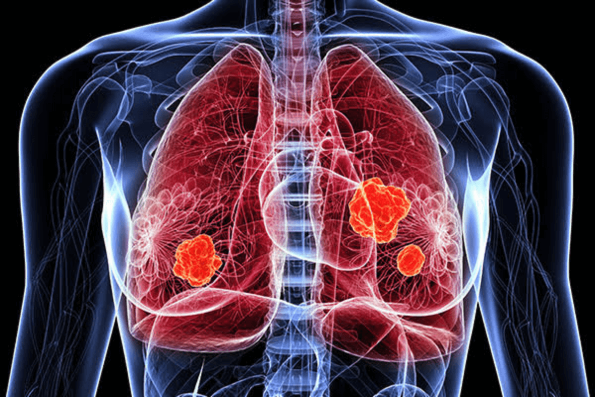 Highly Plastic Cancer Cells Identified as a Key Engine of Lung Tumor Progression | medtigo